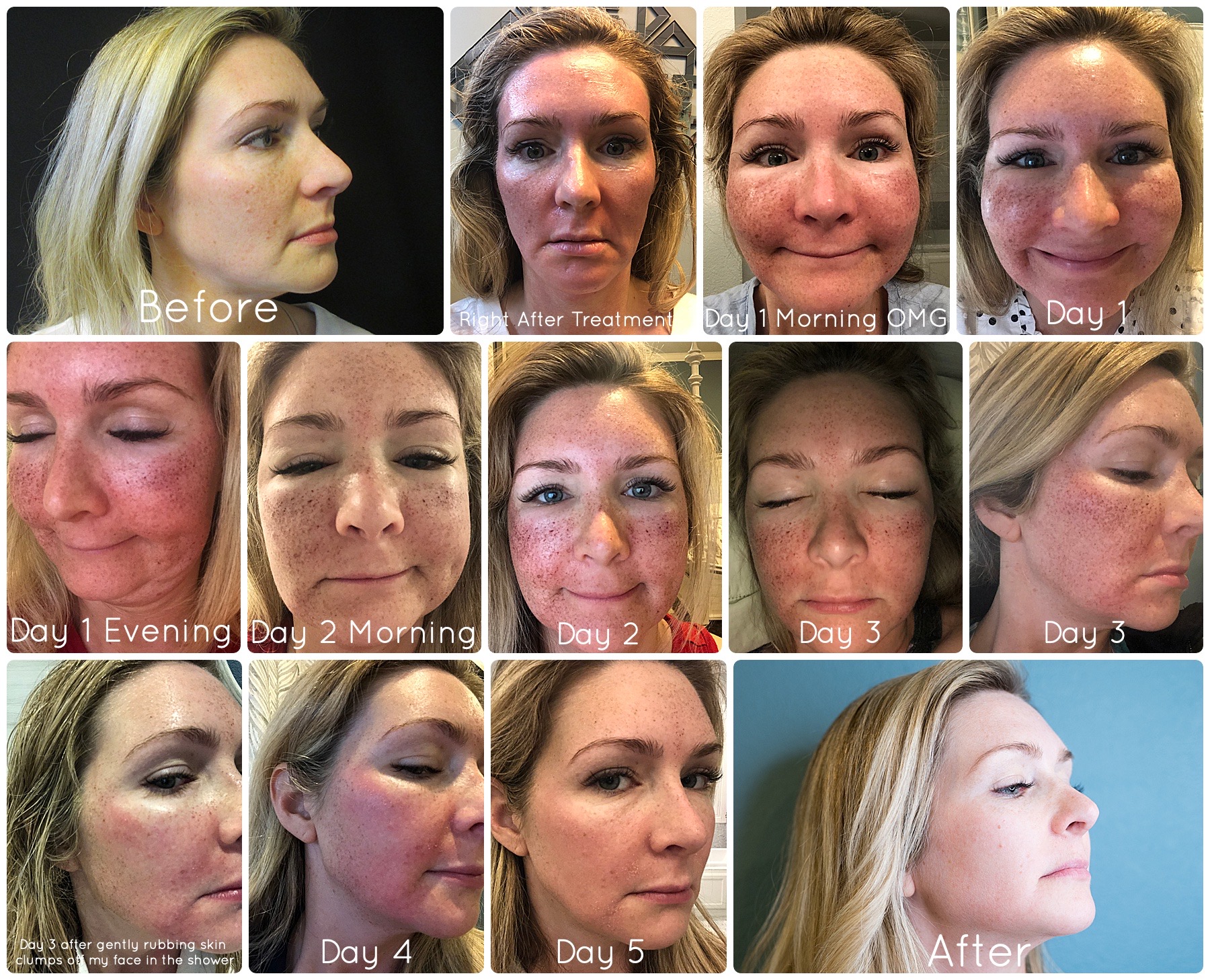 Laser Skin Treatment